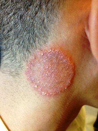 Champignon du mois - Juillet 2020 - Société Française de Microbiologie